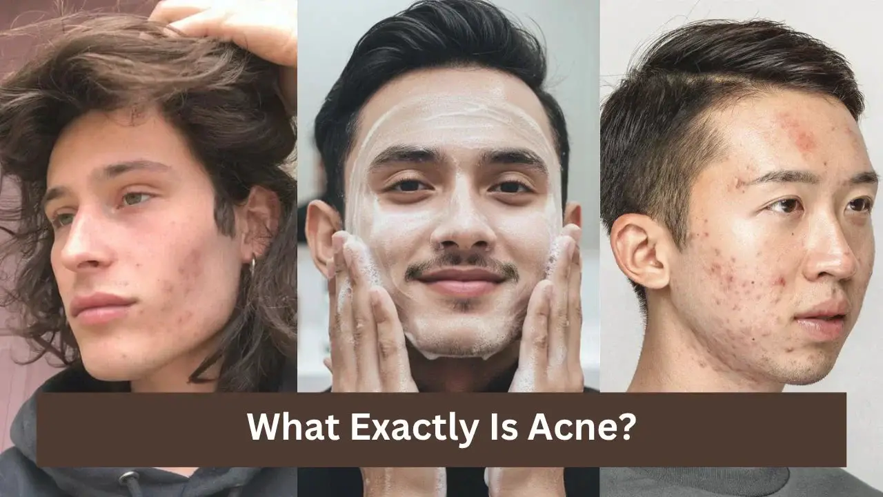 Acne in Men: 5 Common Types, Causes & Proven Treatments for Clear Skin ...